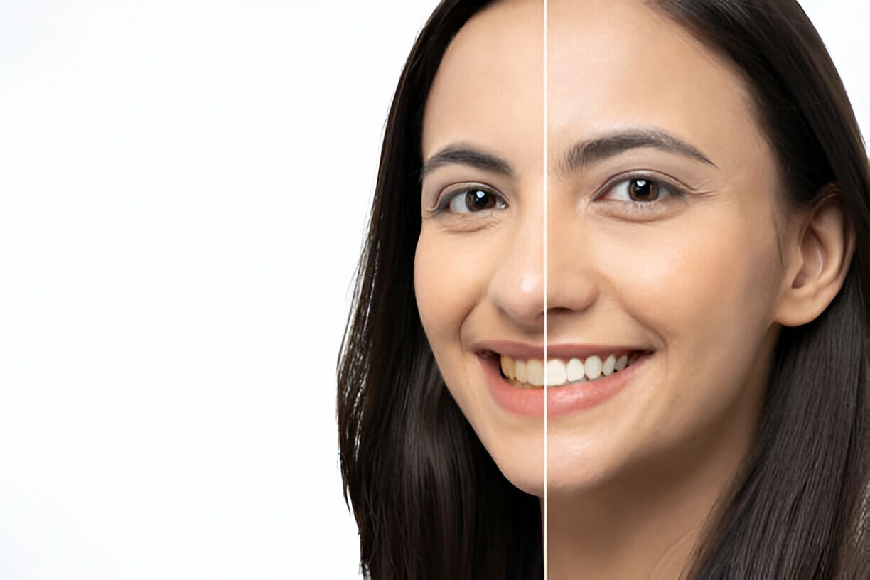 How Much Is Teeth Whitening in Scotland?